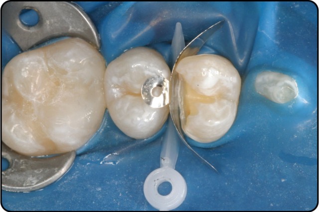 Sure / Dental Innovations, V Ring Technique