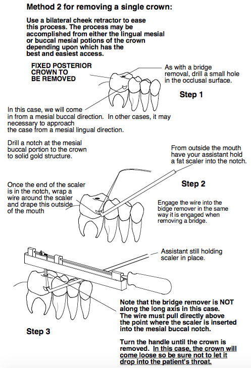Sure Dental | Higa Bridge Remover Manual