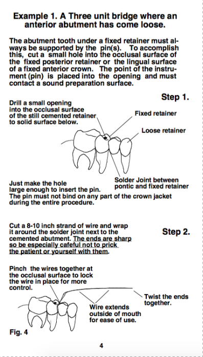 Sure Dental | Higa Bridge Remover Manual