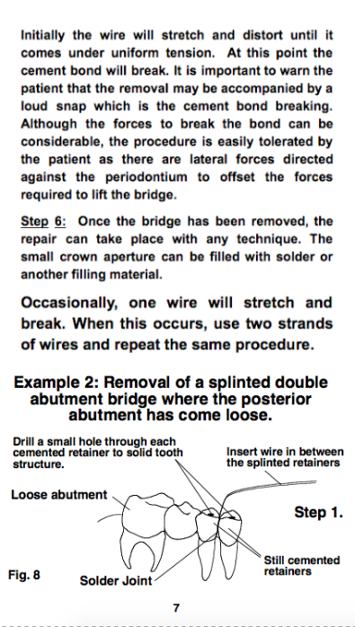 Sure Dental | Higa Bridge Remover Manual