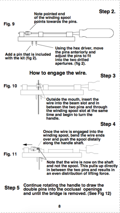 Sure Dental | Higa Bridge Remover Manual